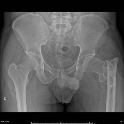 Femur Fracture Detection Instance Segmentation Dataset by Final Project