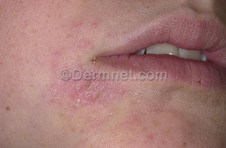 Face Skin Diseases Classification Model by Alvin