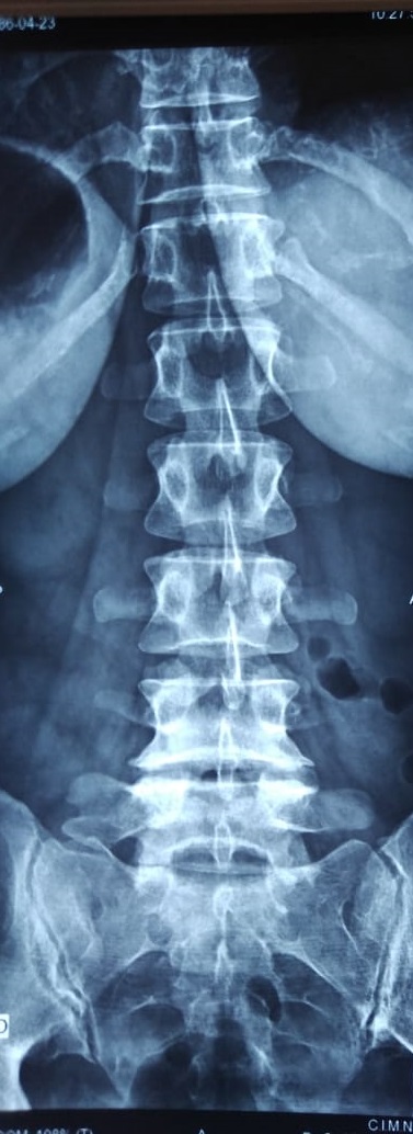 Top Pedicule Datasets and Models | Roboflow Universe