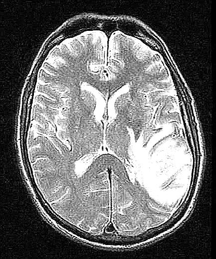 Tumor Detection Object Detection Model By Fast