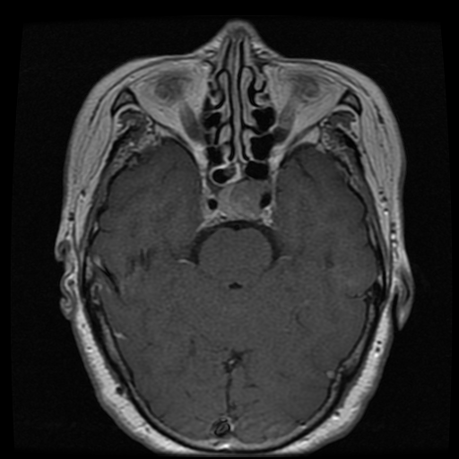 Tumor Otak Object Detection Dataset And Pre Trained Model By Tumor
