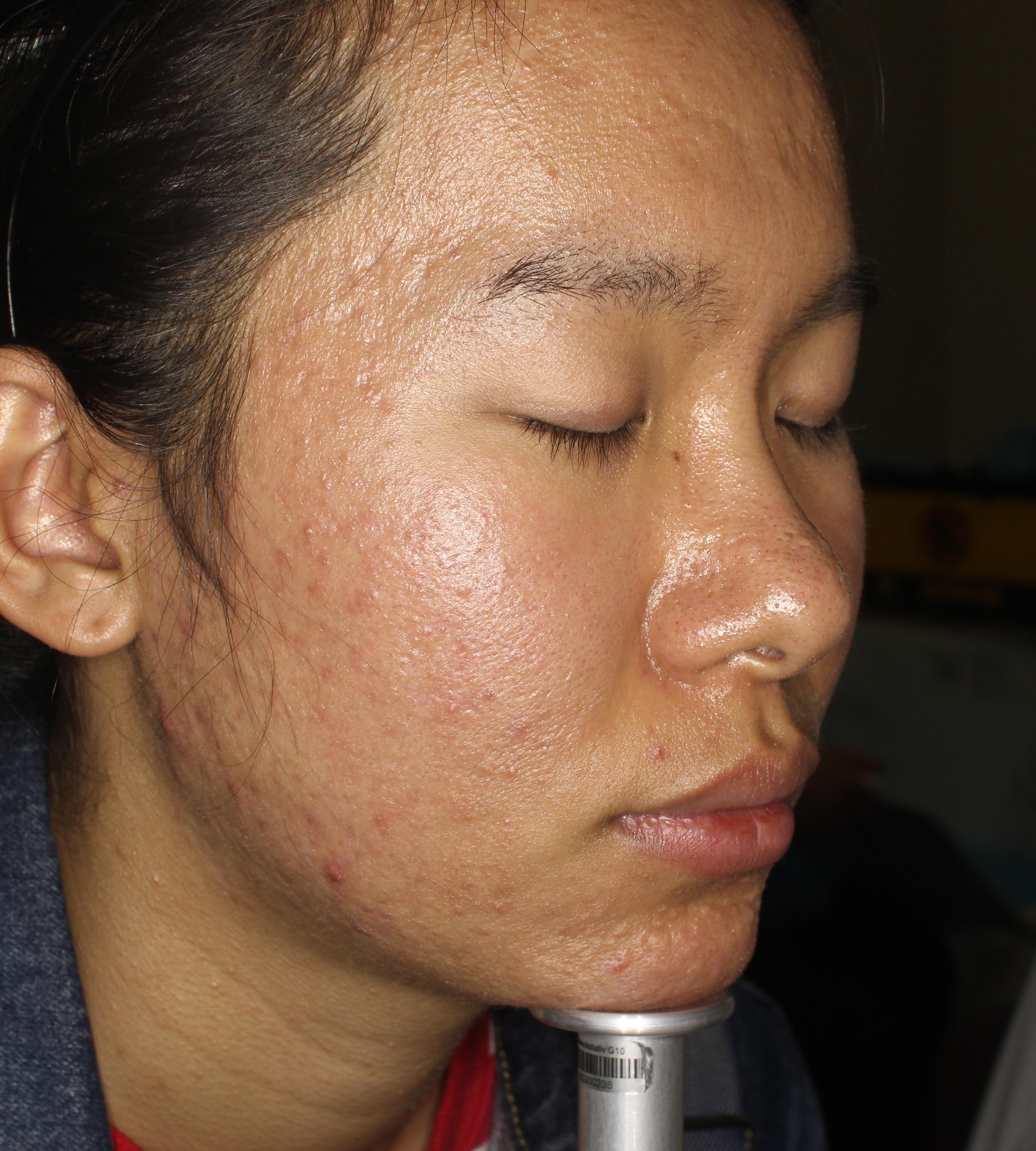 Acne04 Detection Object Detection Dataset And Pre Trained Model By Acne
