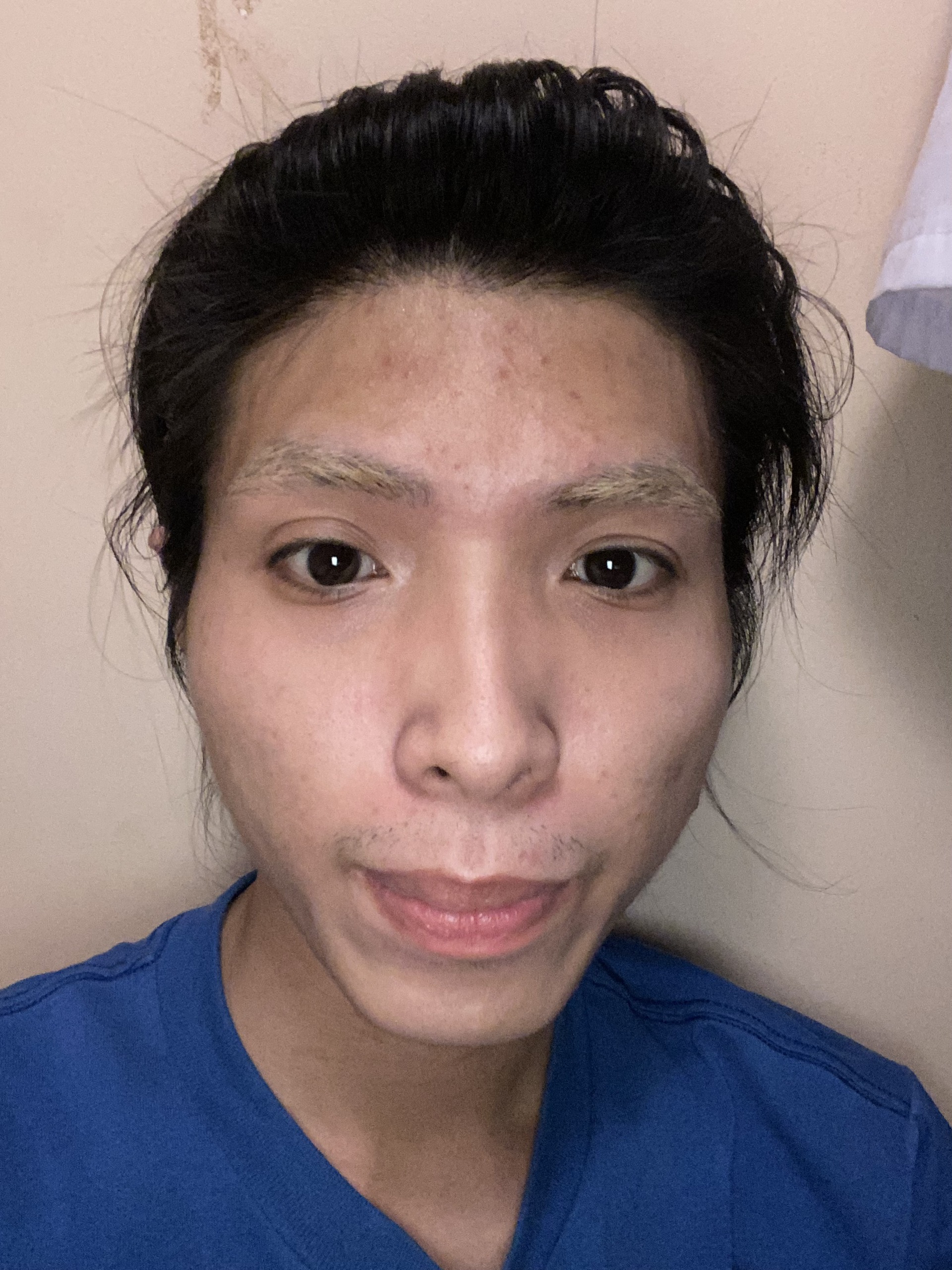 Acne Vulgaris Detection Roboflow Universe