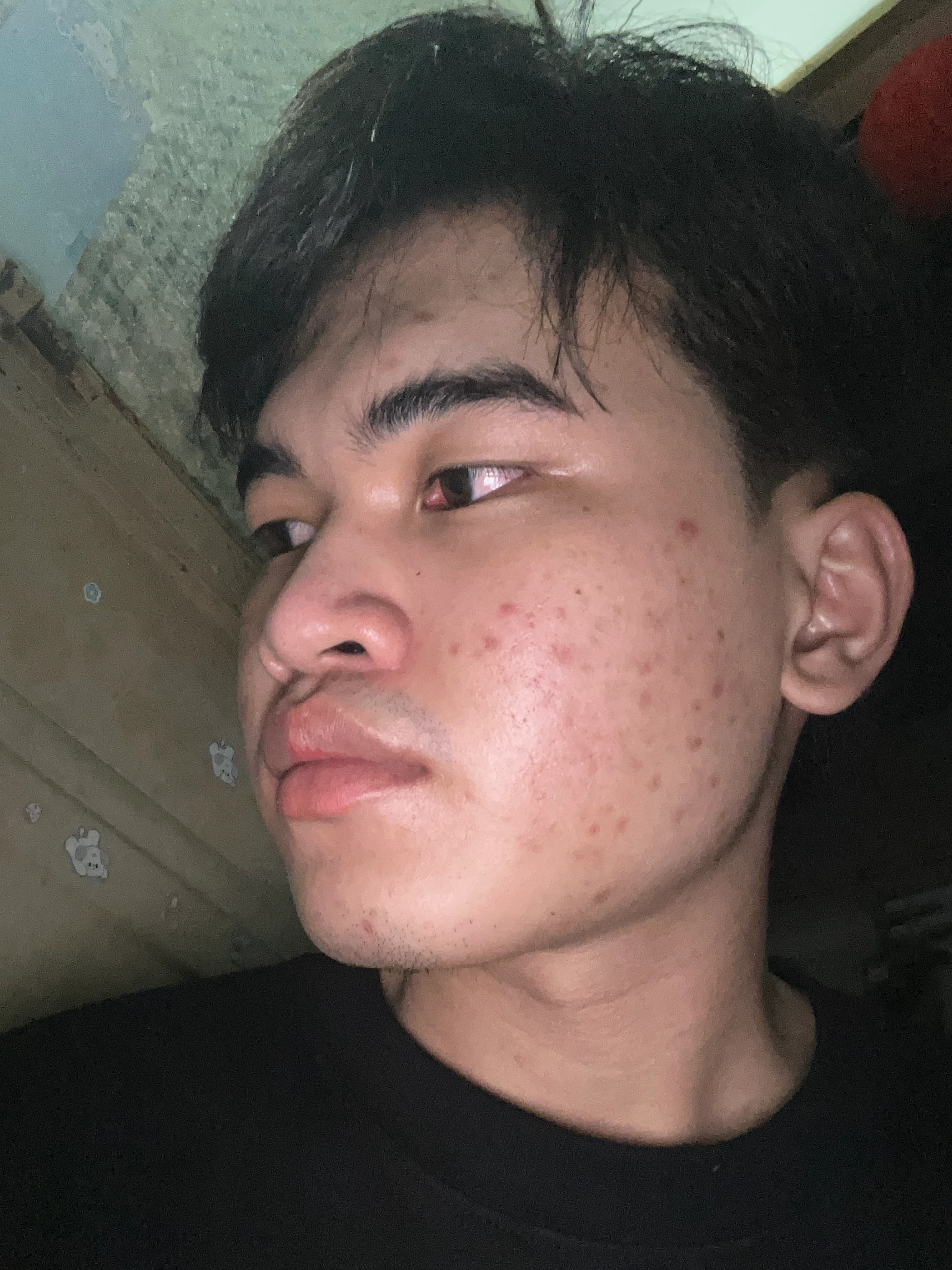 Acne Vulgaris Detection Roboflow Universe