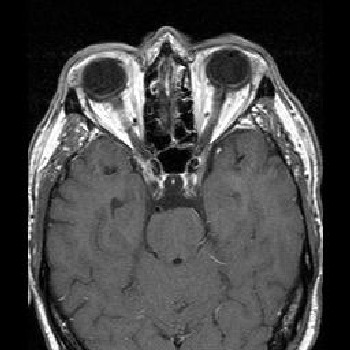mri image processing Object Detection Model by mri brain tumor