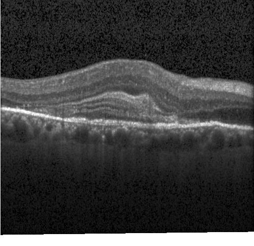 How To Use The Retinal Detachment Object Detection Api