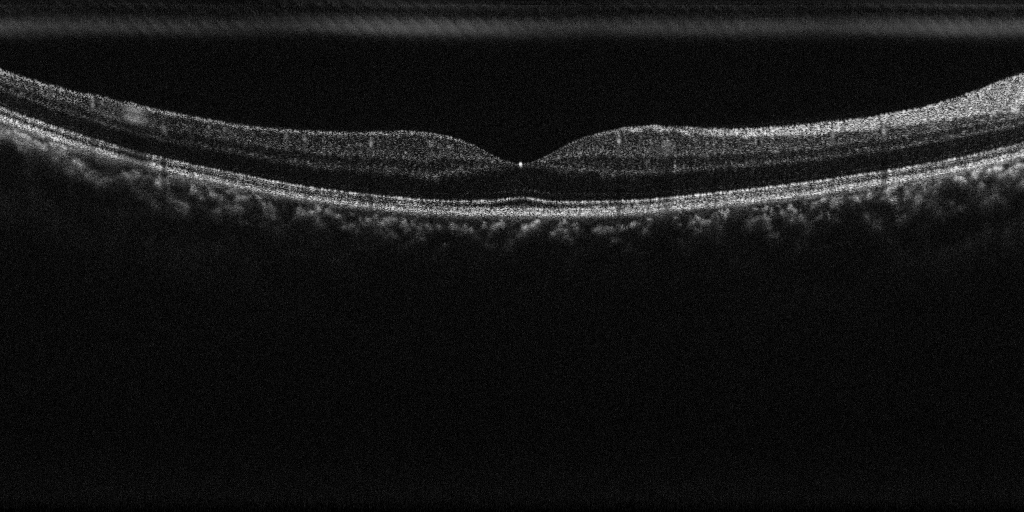 retinal-detachment Object Detection Dataset and Pre-Trained Model by ...