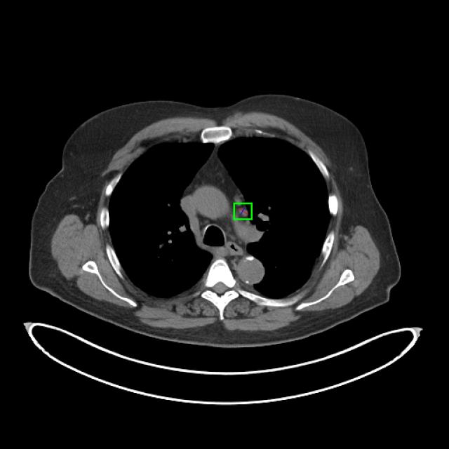 Lung Cancer2 Object Detection Dataset And Pre Trained Model By Bursa