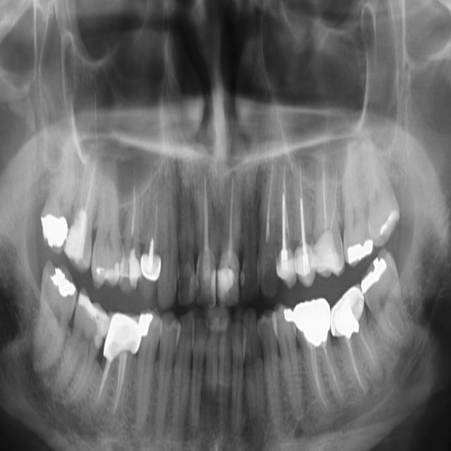 teeth segmentation Object Detection Dataset and Pre-Trained Model by Ramu