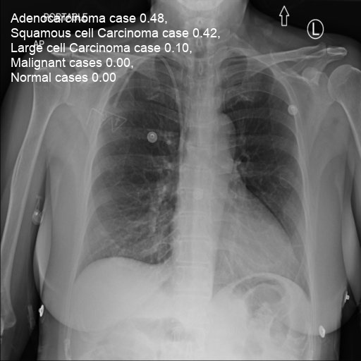Lung Cancer Detection Object Detection Dataset By Object Detection