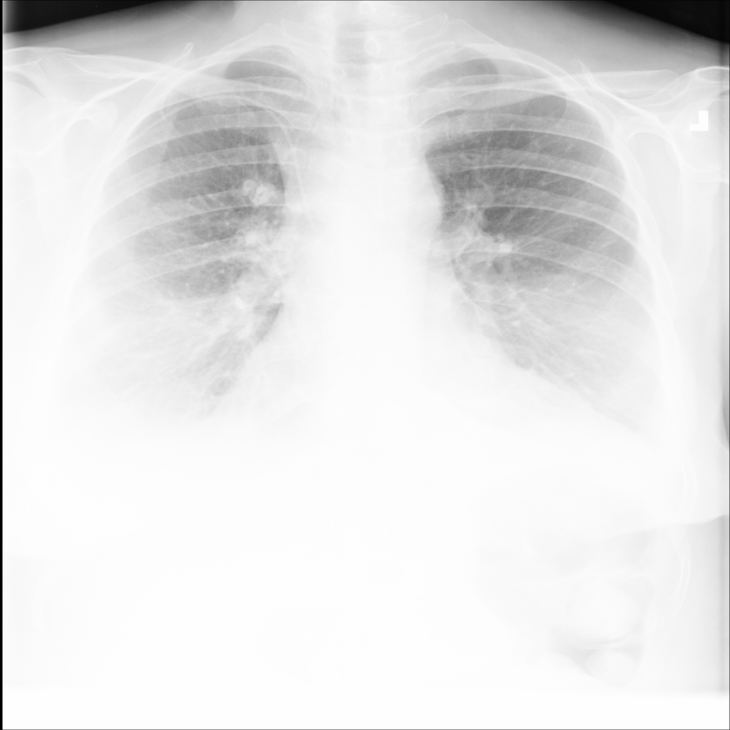 lung cancer Object Detection Dataset by Object Detection