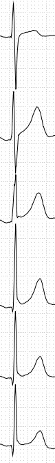 ECG_LVH_2025 Classification Dataset by chuenjai