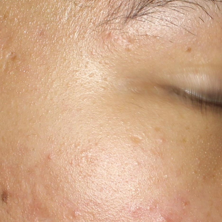 Acnee Object Detection Dataset V3 2023 11 24 3 55pm By Skripsi