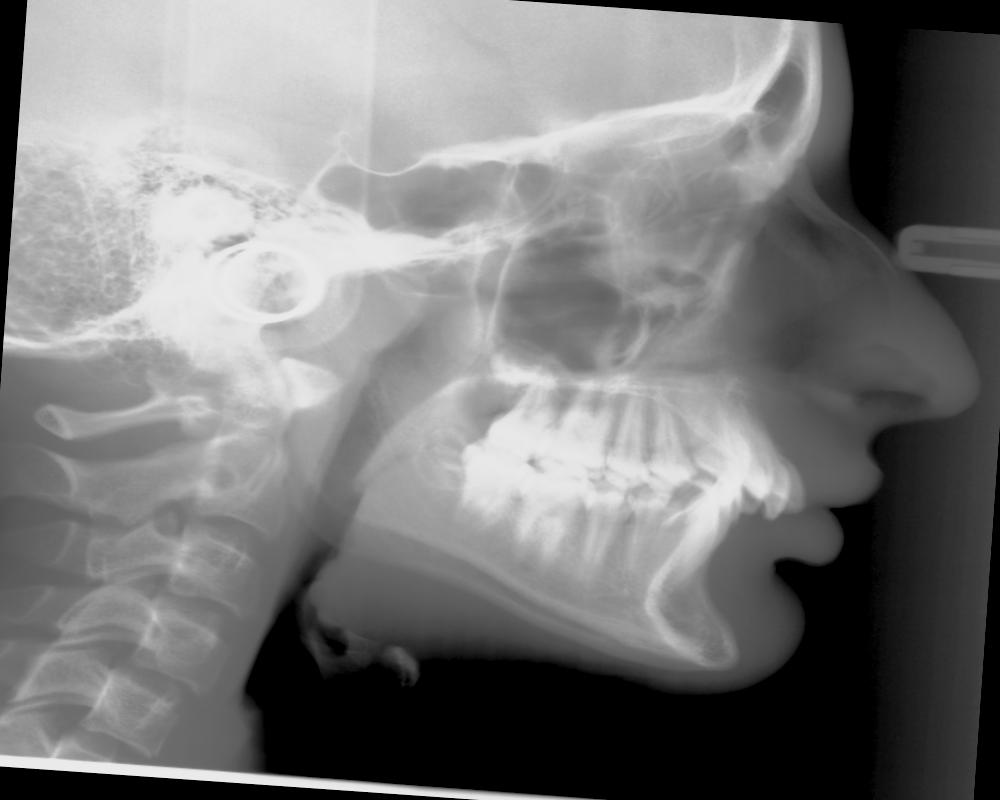 New Dataset And Pre Trained Model By Lower Obstruction Detection