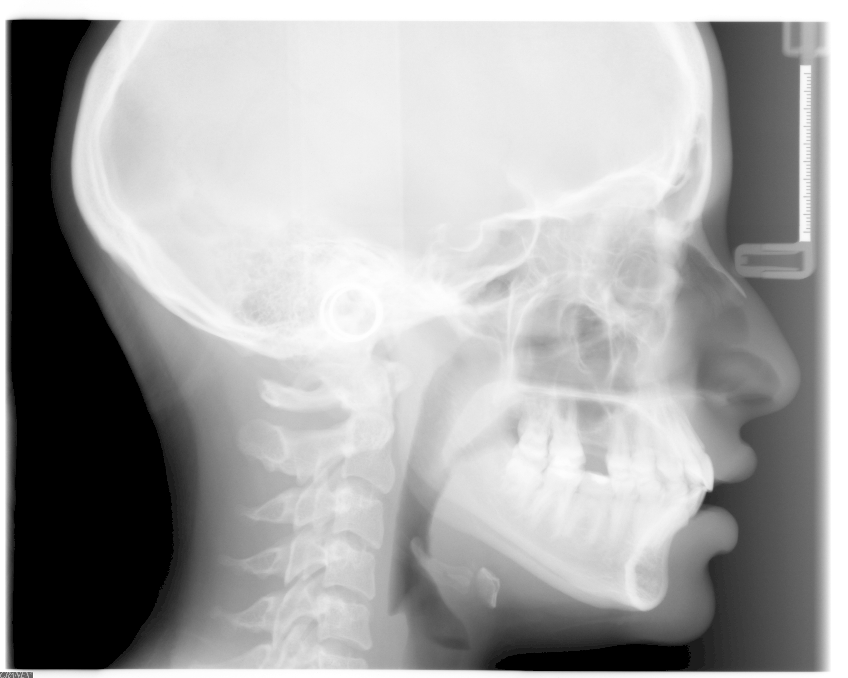lod classification Computer Vision Dataset by lower obstruction detection lod classification Computer Vision Dataset by lower obstruction detection