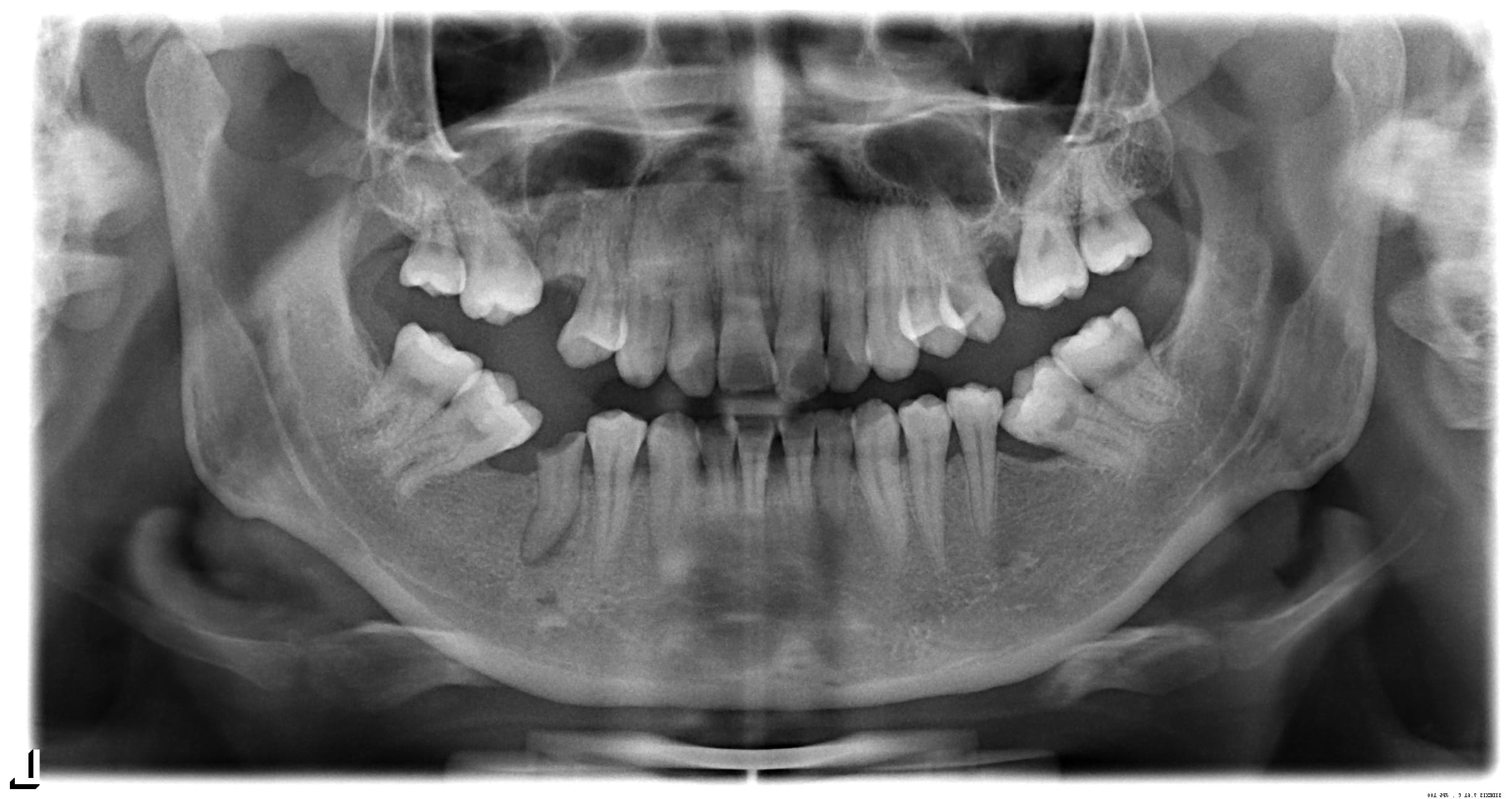 Periodontitis-Apical-Dataset1000 Object Detection Model by Carlos