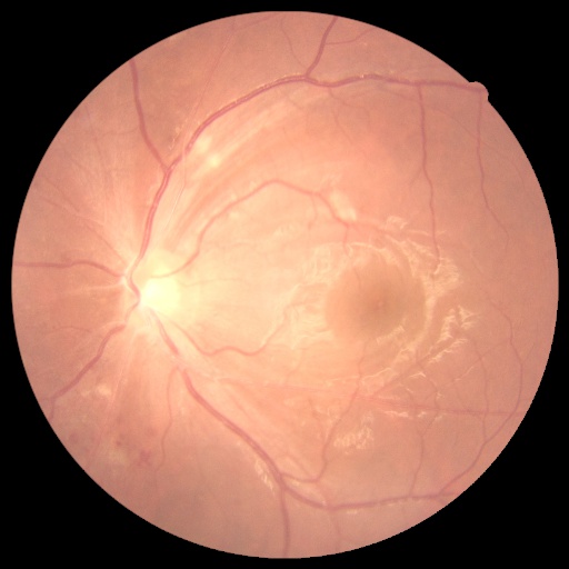 DDR Object Detection Dataset by Aptos and DDR