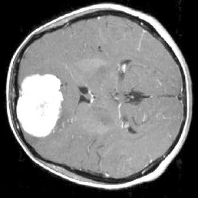 Tumor Detection University Instance Segmentation Model By Brain Tumor Test
