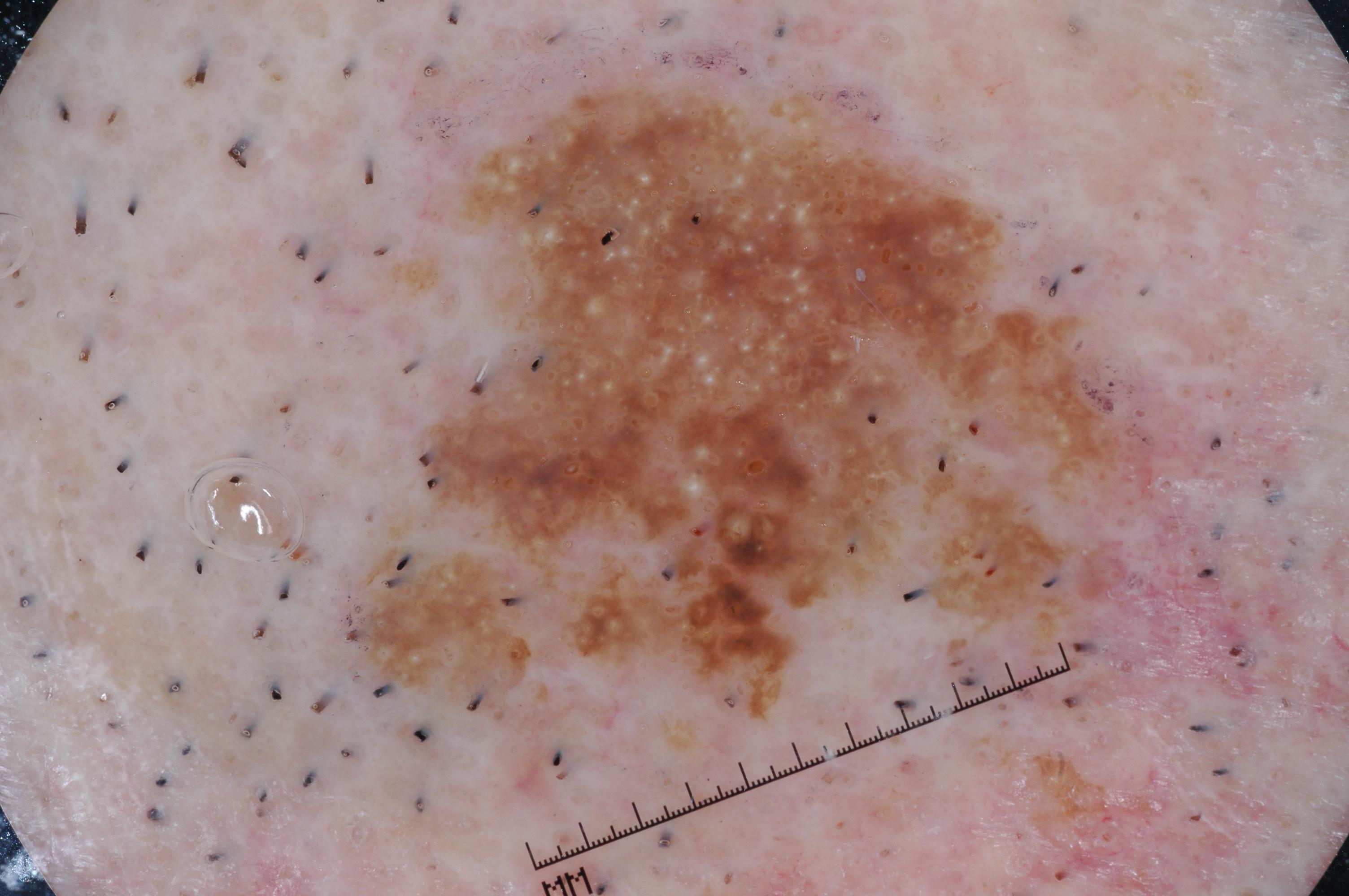 skin cancer 5 Classification Dataset by practice