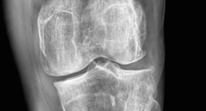 oa_mild Instance Segmentation Dataset by Kneedianosis