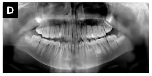 How to Use the odontoma segmentation Instance Segmentation API