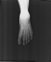 Fracture Detection Instance Segmentation Dataset and Pre-Trained Model by Personal