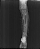 Fracture Detection Instance Segmentation Dataset and Pre-Trained Model by Personal