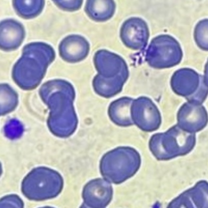 bcc Object Detection Dataset and Pre-Trained Model by platelet