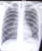 Pneumonia-detection-final Object Detection Dataset and Pre-Trained ...