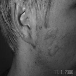 acne-gan Object Detection Dataset and Pre-Trained Model by ance yolo