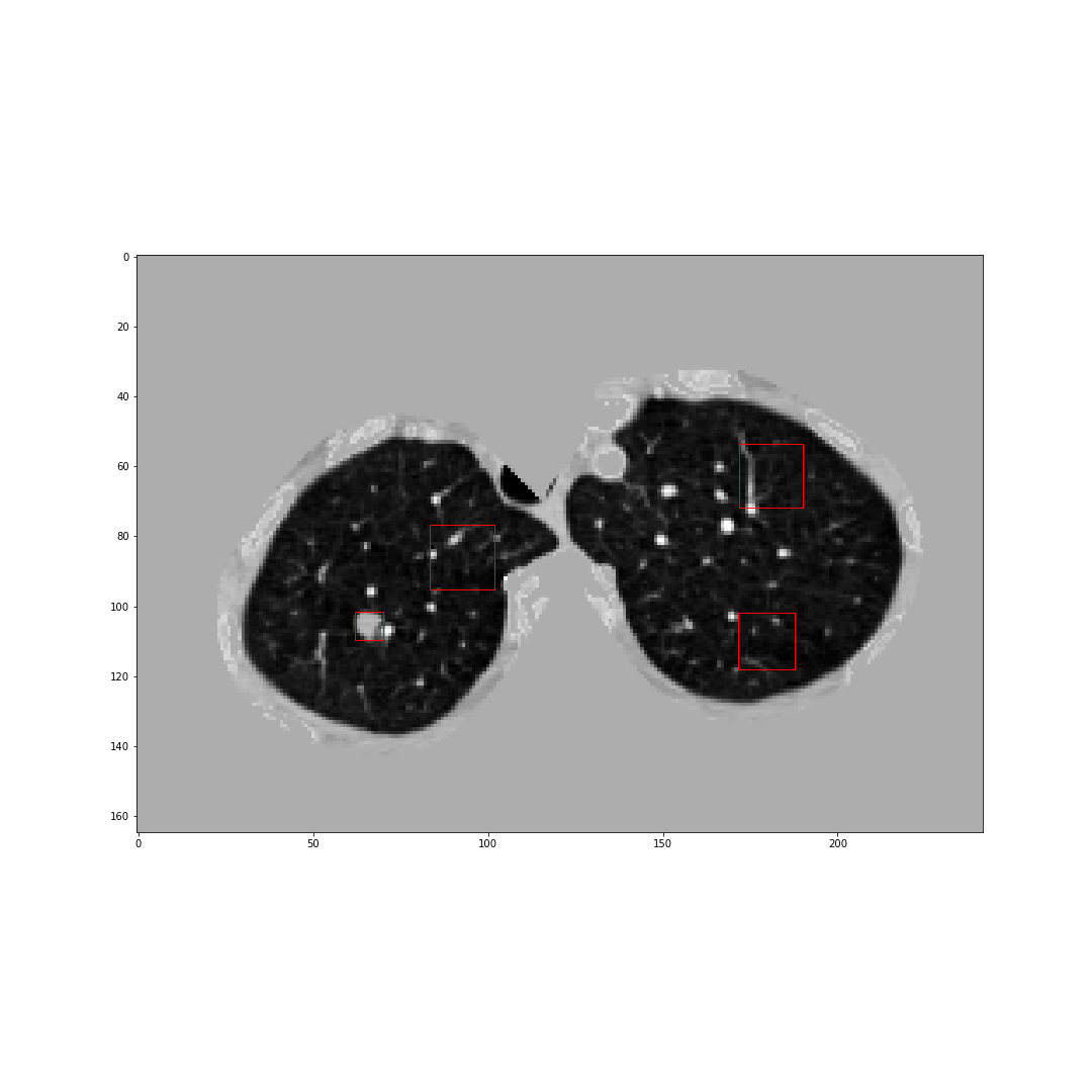 Luna16 Deeplearning Lung Nodule Detection Object Detection Dataset And
