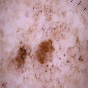 skin cancer Classification Dataset by satakshi mishra
