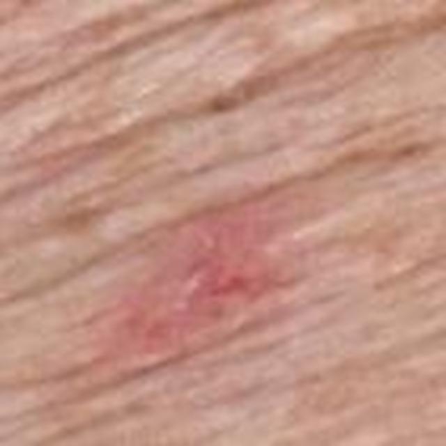 Skin Cancer Detection Object Detection Dataset By Computer Vision Project