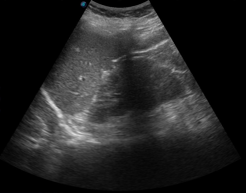 kidney Classification Model by olfa
