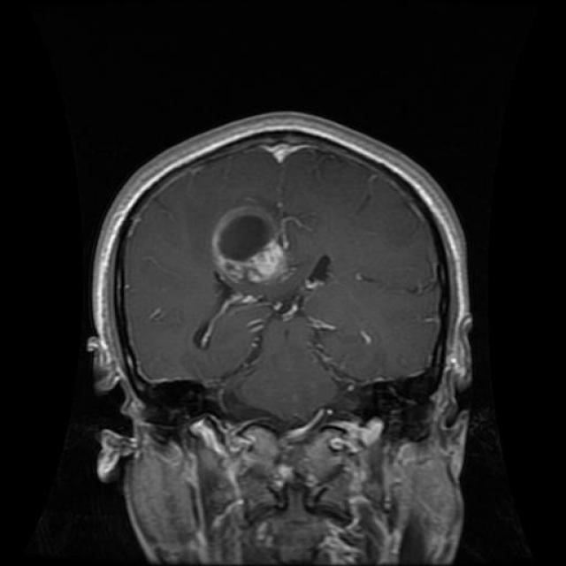 Brain Tumor Detection Object Detection Dataset and Pre-Trained Model by Braintumordetection