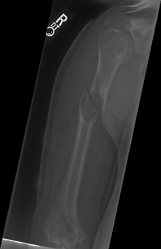 Bone Fracture Detection Object Detection Dataset by Bone Fracture Detection