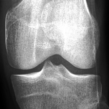 Knee Joint Space Detection Object Detection Dataset By Kneejointspace