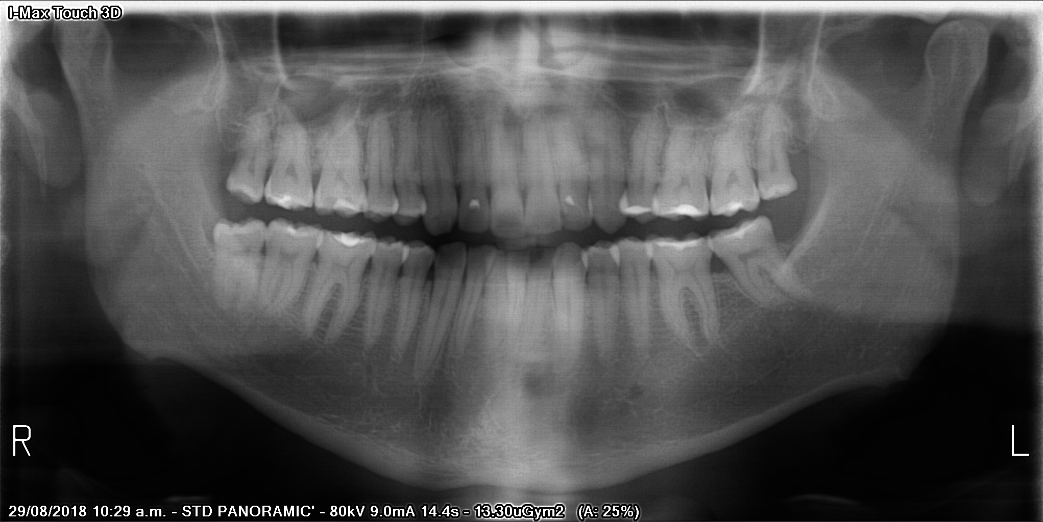 Teeth Segmentation Instance Segmentation Dataset and Pre-Trained Model by Noursine Baldi