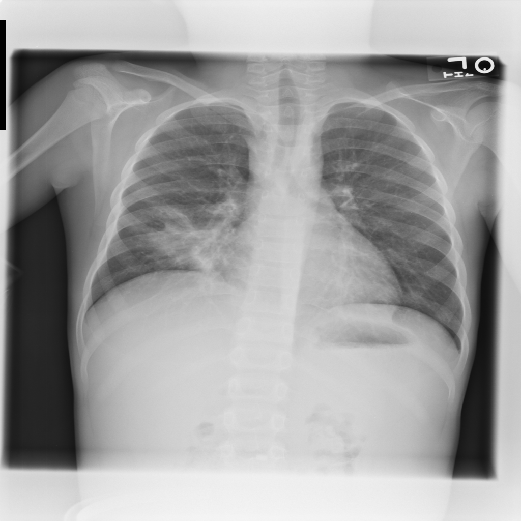 CXR Object Detection Model by Andrew White