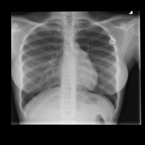 LUNGs Object Detection Model by Lung detection