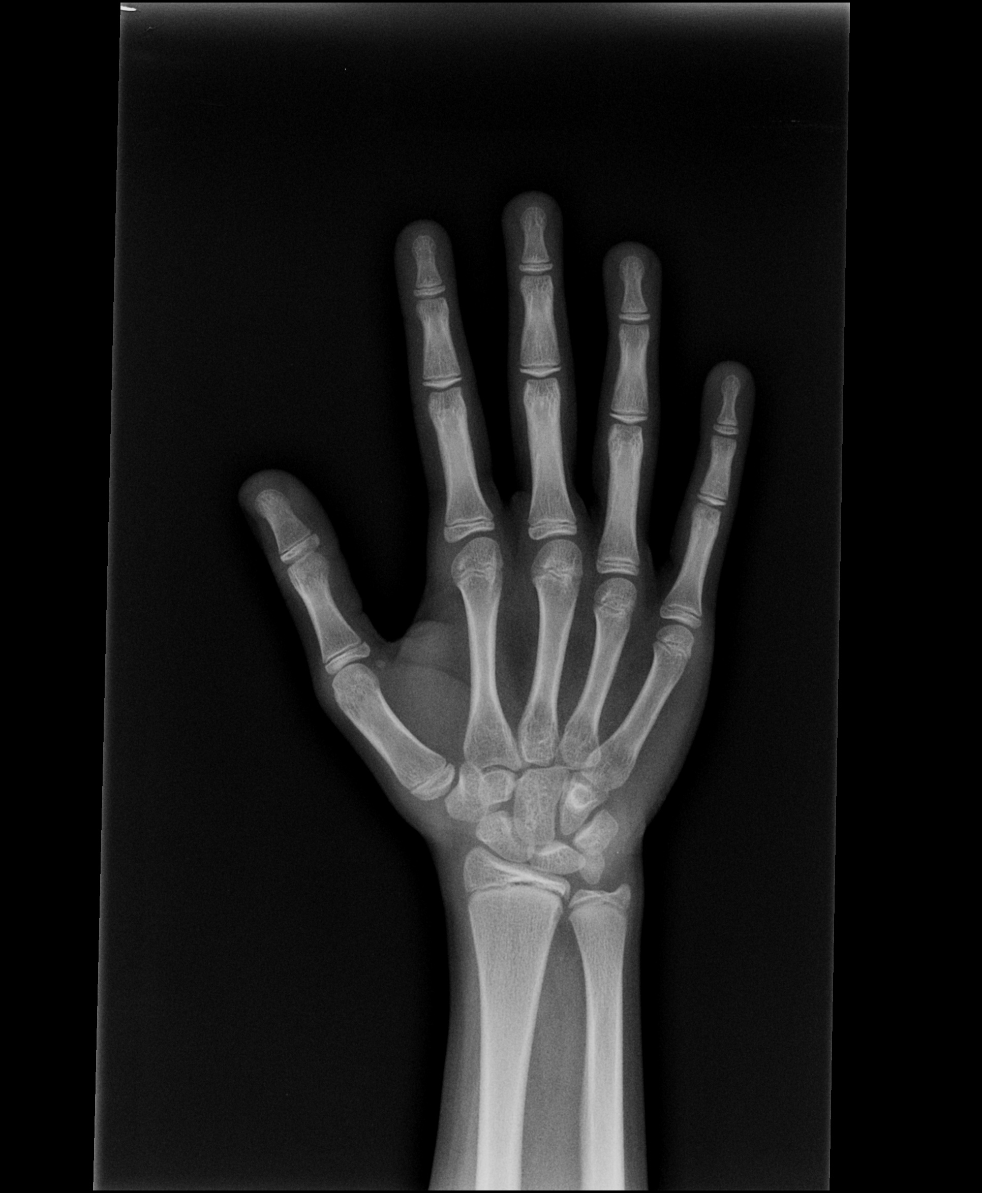 Bone Age Object Detection Dataset And Pre Trained Model By Universidade Presbiteriana Mackenzie