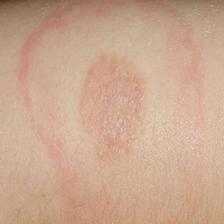 Bug Bite Object Detection Model by bug bite