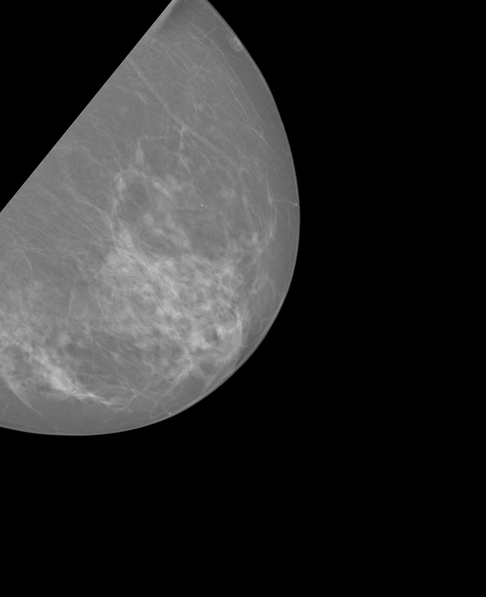 InBreast Instance Segmentation Dataset by Labeling