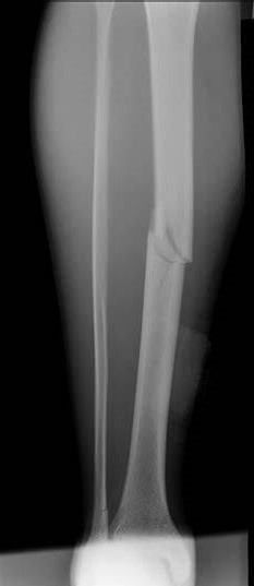 Fractured Detection Object Detection Model By Final Project Image Processing