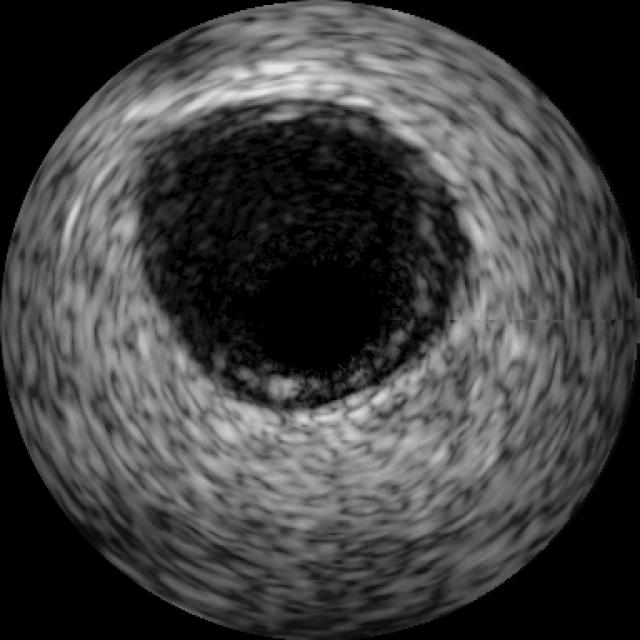 segment Instance Segmentation Dataset and Pre-Trained Model by IVUS