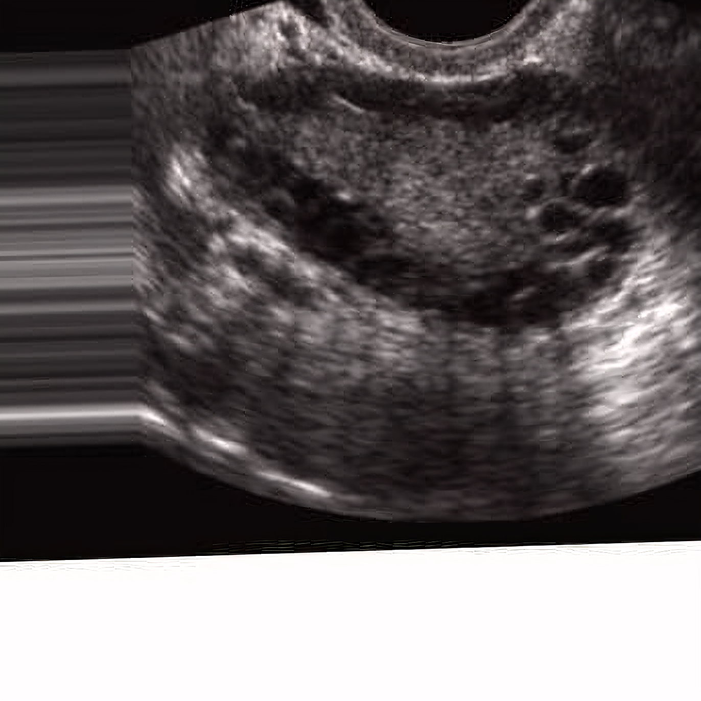 PCOS (pcos-gsgip) - Roboflow Universe