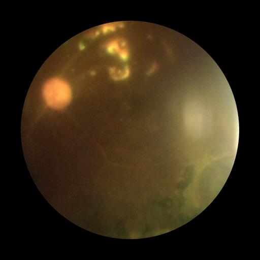 retina_default Instance Segmentation Dataset by thastp