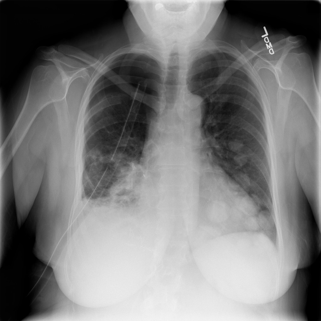 Pneumonia Detection Object Detection Dataset By Yash