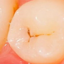 ver10_01_caries_detection Object Detection Dataset by hlmnbr