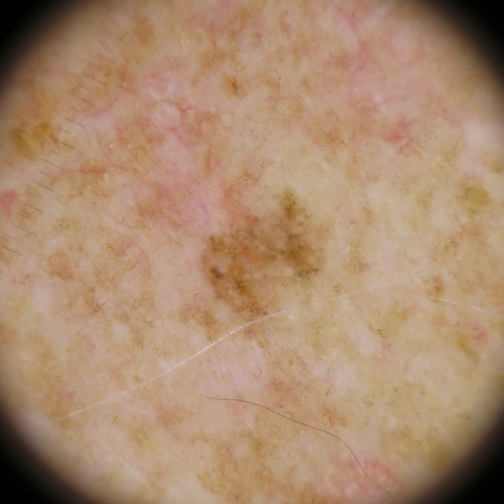 skin Classification Dataset by cancer